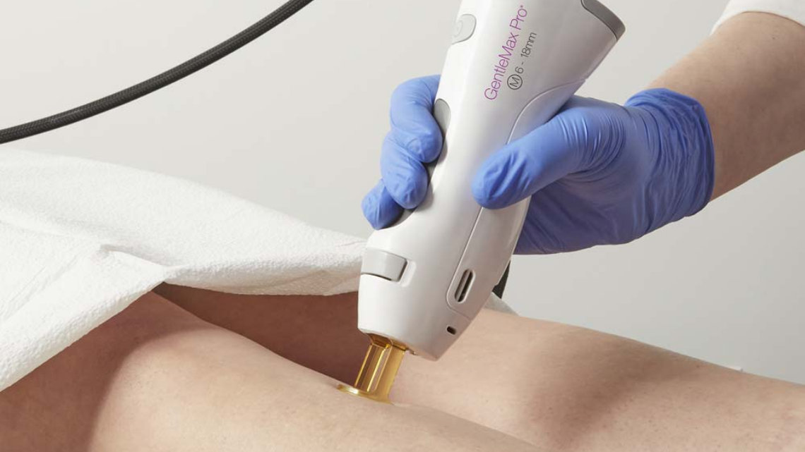 Full Body Laser Hair Removal in Staten Island | Silky Smooth Skin